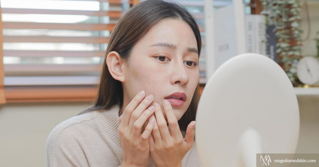 Learn How To Prevent Acne Breakouts With MMA | Magnolia Medical ...